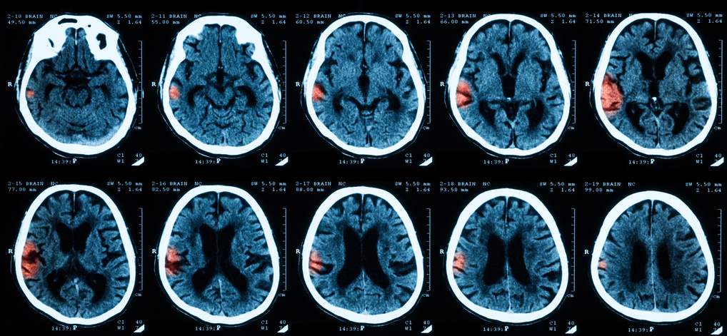 Neurology Conditions Treatment Anniston, AL | RMC